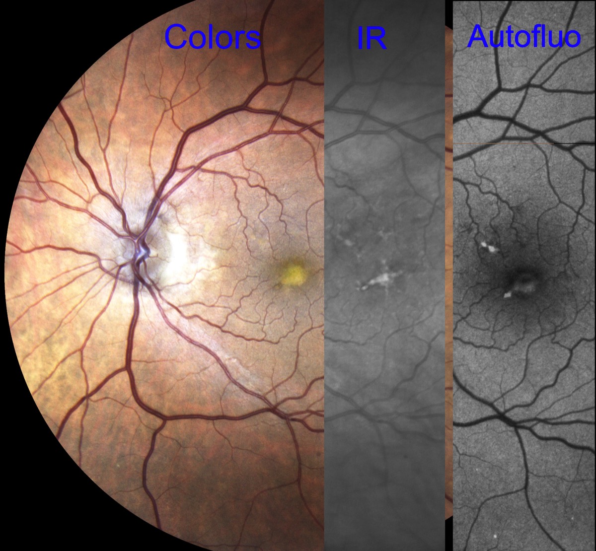 nouveau rétinographe EIDON - Ophtalmocéan